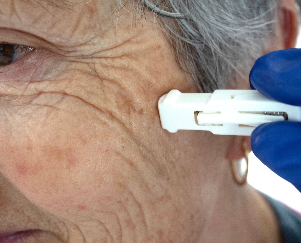 Harpera, a new skin microbiopsy tool for dermatological research
